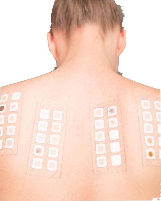 การทำ Patch Test สำหรับผิวเเพ้ง่าย คืออะไร?