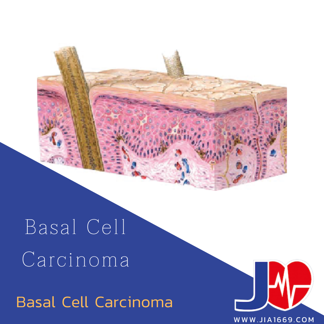 basal cell carcinoma มะเร็งเซลล์ต้นกำเนิด - jia1669