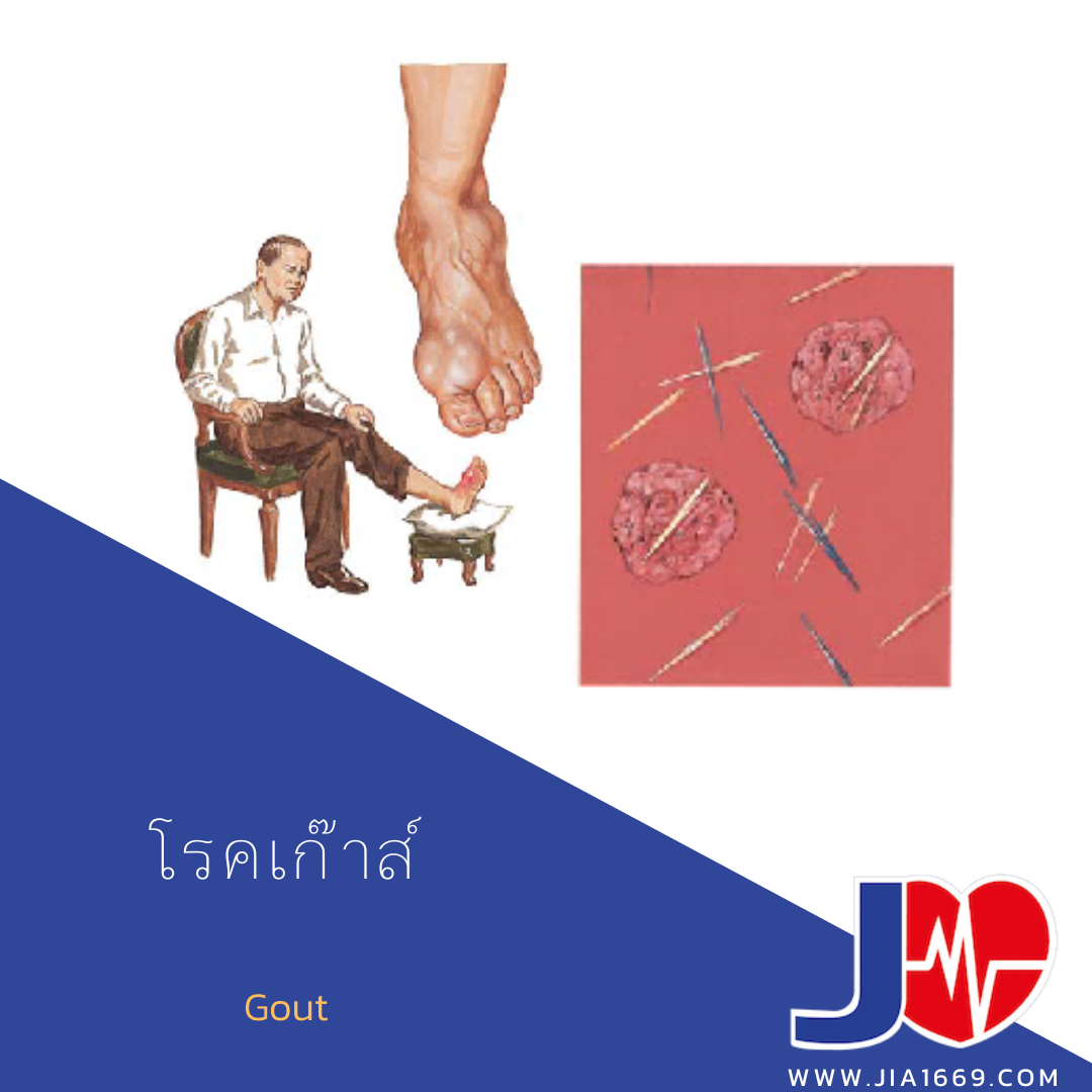 โรคเก๊าส์ - jia1669