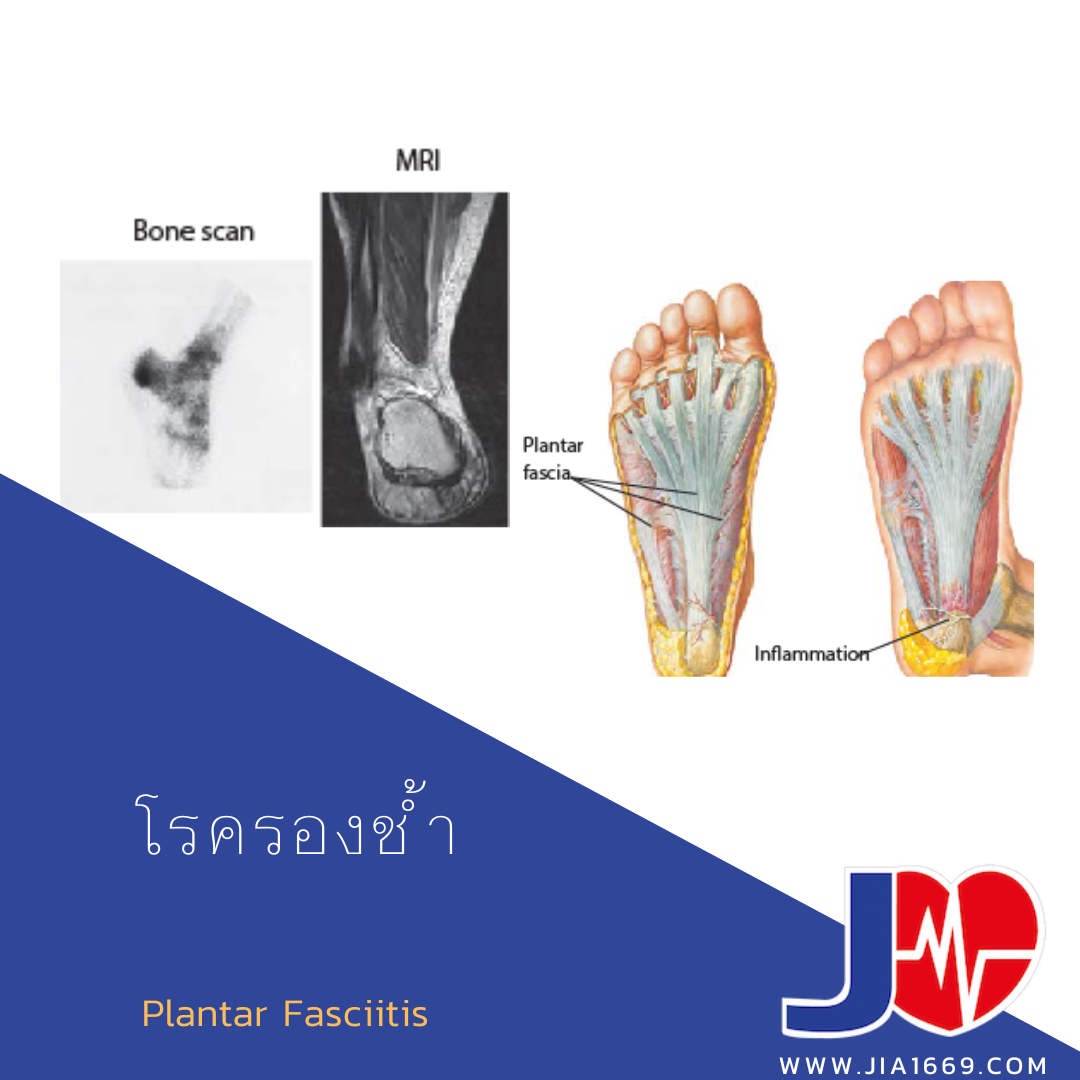 โรครองช้ำ - jia1669