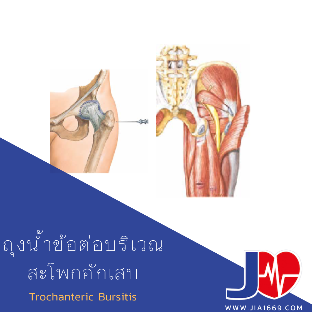 Trochanteric Bursitis - jia1669
