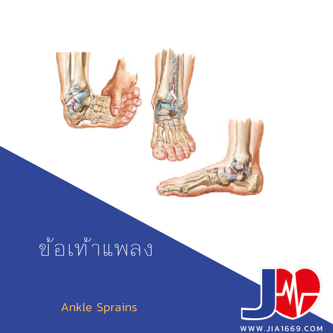 Ankle Sprains - jia1669