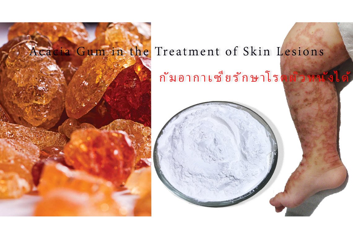 Use of Acacia Gum in the Treatment of Skin Lesions