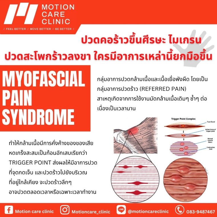 โรค Myofascial pain syndrome (MPS) กลุ่มอาการปวดกล้ามเนื้อ