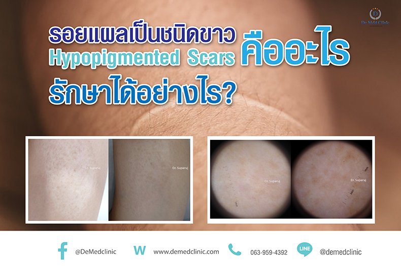 รอยแผลเป็นชนิดขาว Hypopigmented Scars คืออะไร รักษาได้อย่างไร?