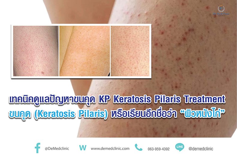 เทคนิคดูแลปัญหาขนคุด KP Keratosis Pilaris Treatment ขนคุด (Keratosis ...