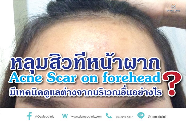 หลุมสิวที่หน้าผาก Acne Scar on forehead มีเทคนิคดูแลต่างจากบริเวณอื่น ...