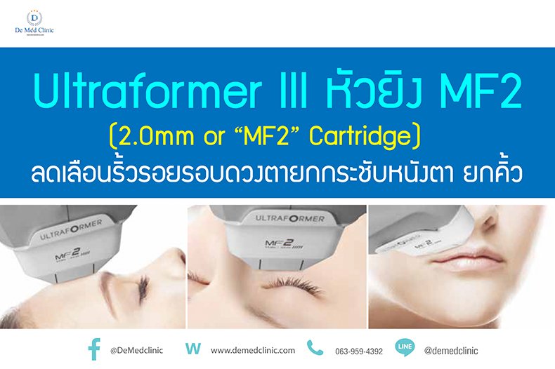 Ultraformer lll หัวยิง MF2 (2.0mm or “MF2” Cartridge) ลดเลือนริ้วรอยรอบ ...