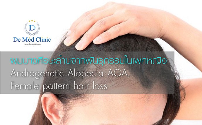 ผมบางศีรษะล้านจากพันธุกรรมในเพศหญิง Androgenetic Alopecia AGA, Female ...