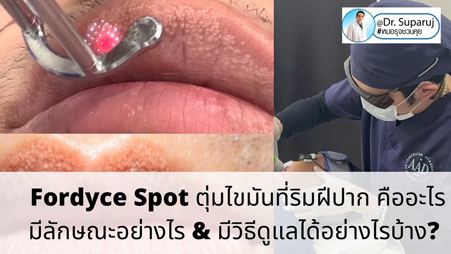 Fordyce Spot ตุ่มไขมันที่ริมฝีปาก คืออะไร มีลักษณะอย่างไร & มีวิธีดูแล ...