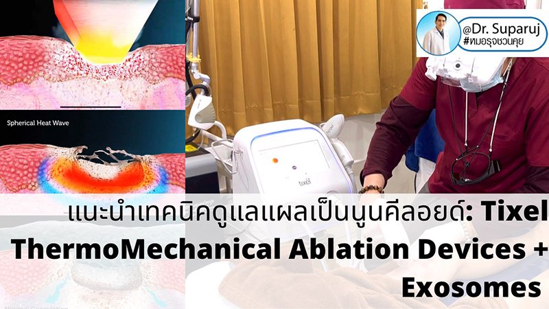 แนะนำเทคนิคดูแลแผลเป็นนูนคีลอยด์: รักษาแผลเป็นนูนด้วยทิกเซลล์ Tixel ...