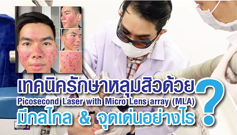 เทคนิครักษาหลุมสิวด้วย Picosecond Laser with Micro Lens array (MLA) มี ...