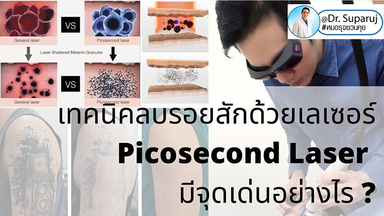 เทคนิคลบรอยสักด้วยเลเซอร์ Picosecond Laser มีจุดเด่นอย่างไร
