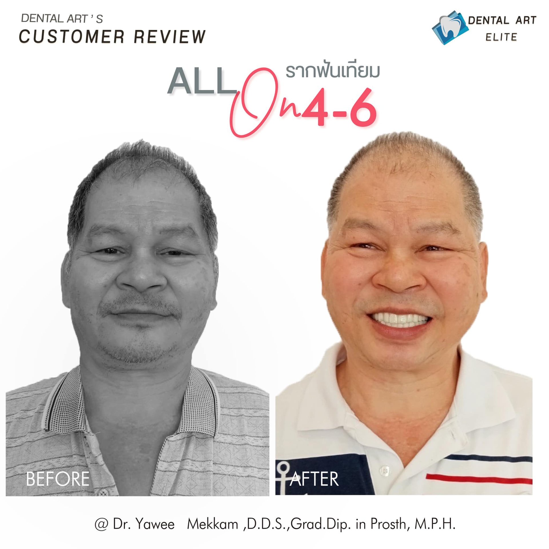 ศูนย์รากฟันเทียม จัดฟันฟันใส invisalign Dental Art Elite