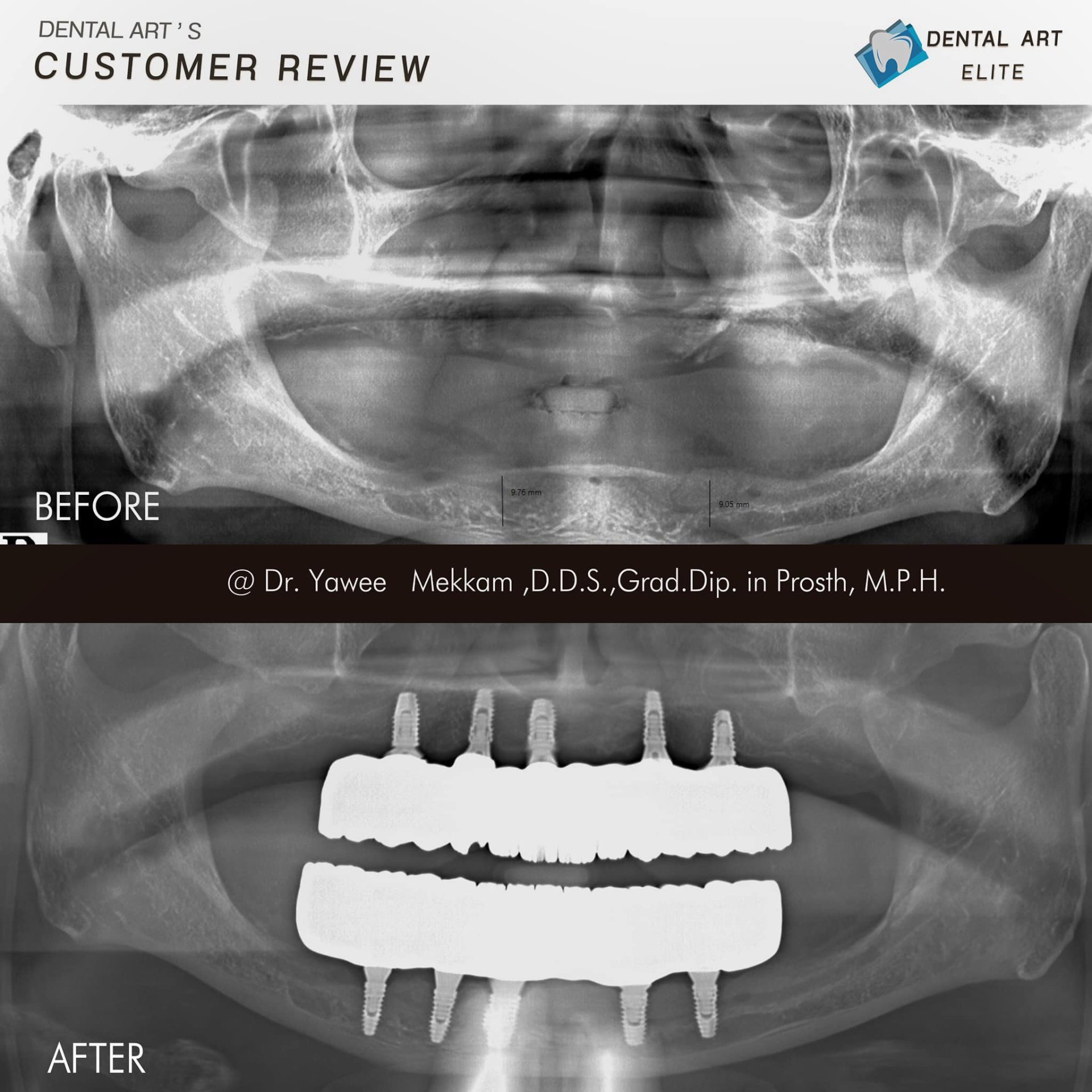 ศูนย์รากฟันเทียม จัดฟันฟันใส invisalign Dental Art Elite